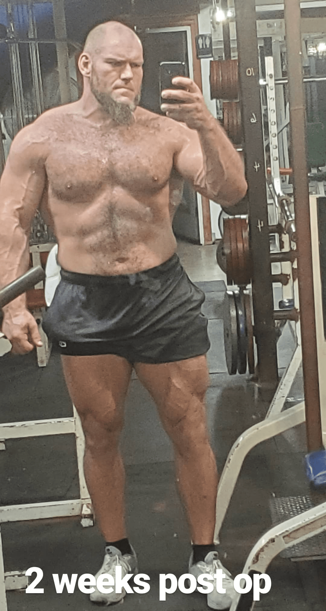 Lars Sullivan In Fantastic Shape Two Weeks After Surgery